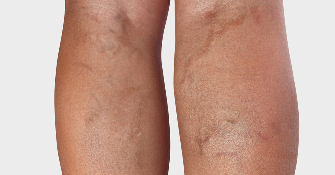 Varices - Juzo